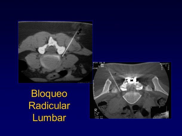 Bloquea radicular, el procedimiento por el que murió una joven en Recoleta