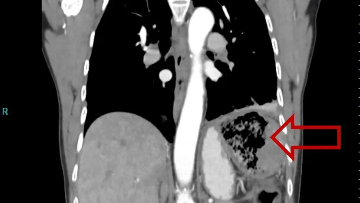Insólito: una mujer vivió 20 años con una gasa en el intestino