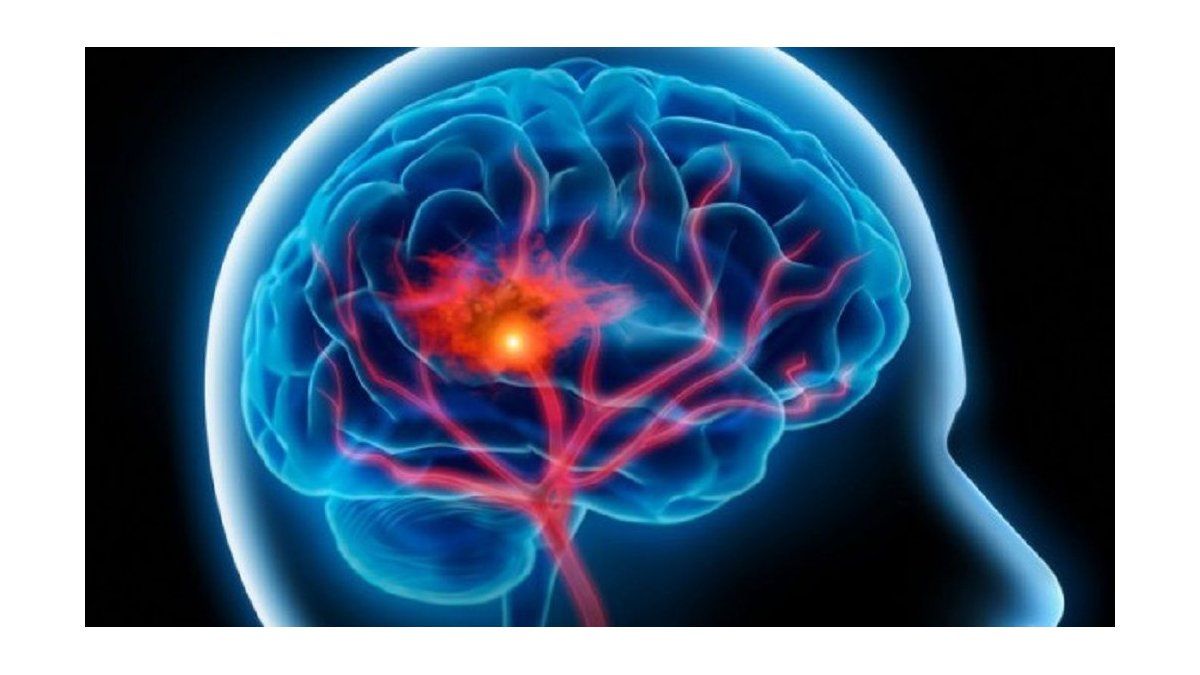 Las señales que hay que tener en cuenta para prevenir un ACV