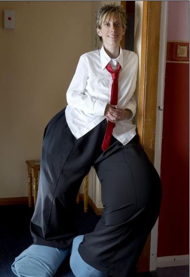 El increíble caso de la mujer con piernas que no paran de crecer