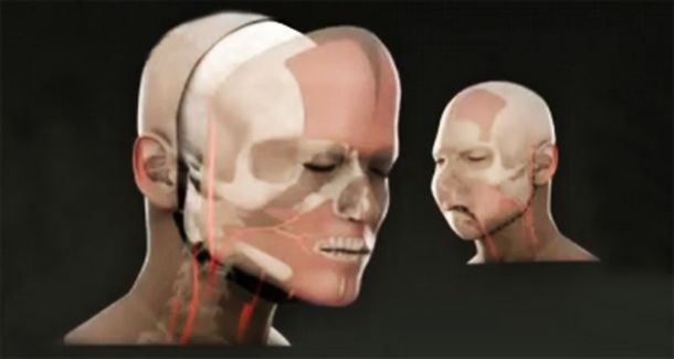 Cómo se realizó el primer trasplante total de cara