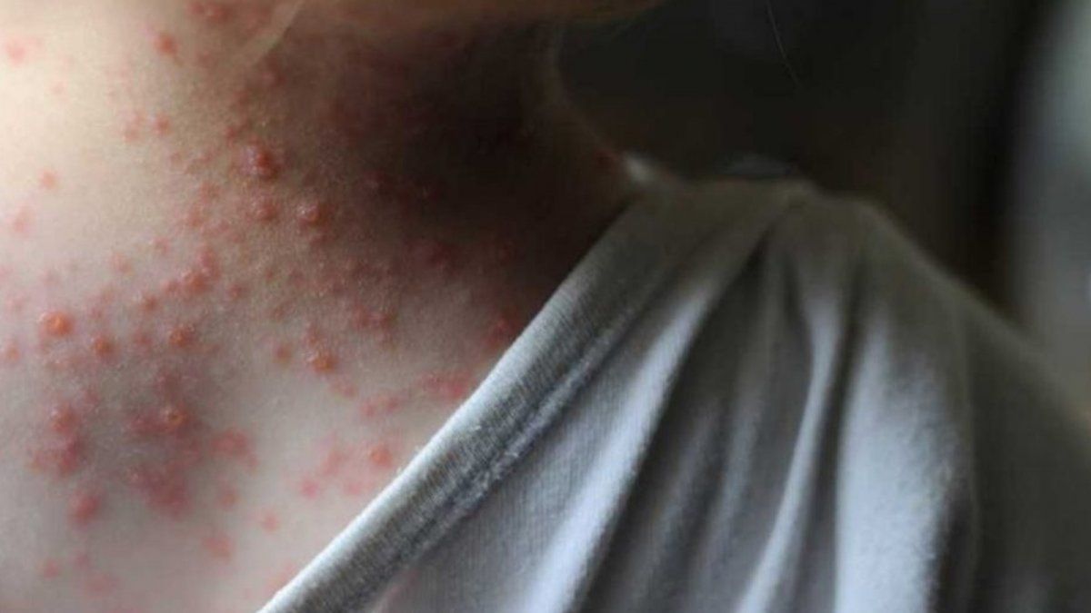 Ministerio de Salud confirmó quinto caso de viruela símica en el país