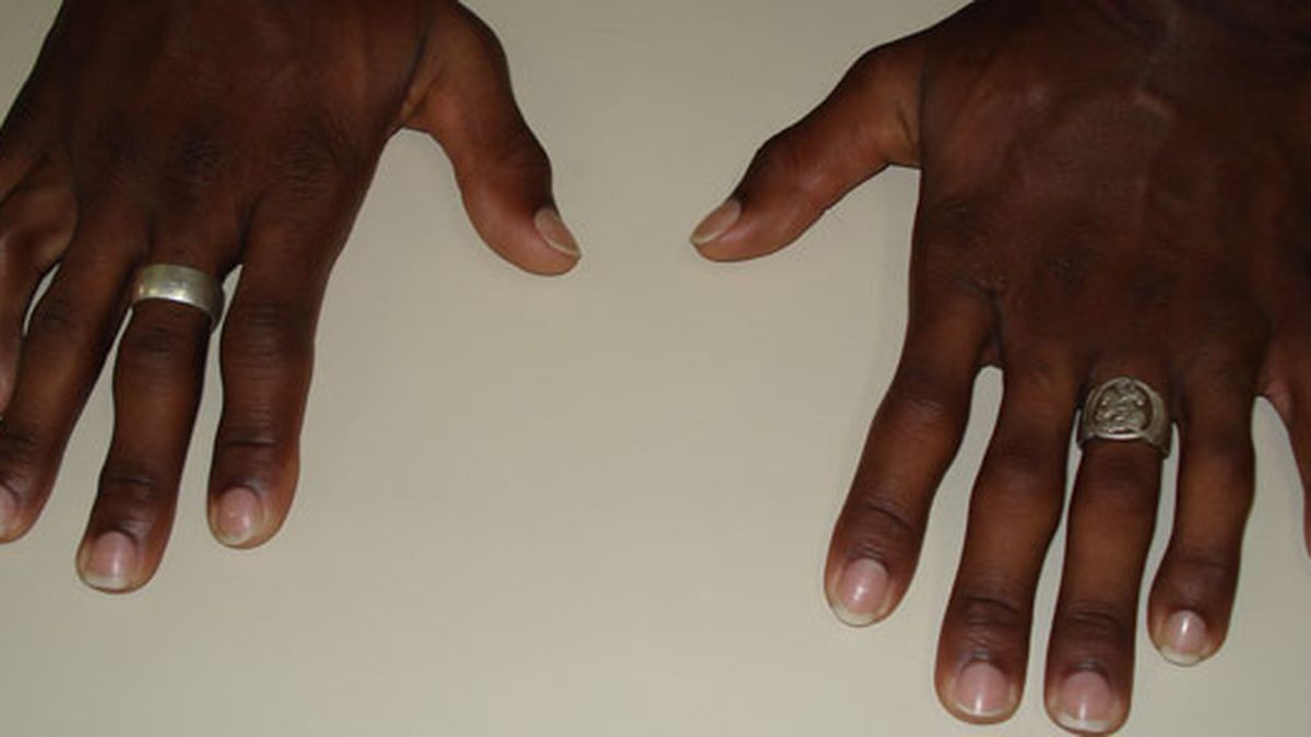 Identificaron a un narco porque tiene doce dedos