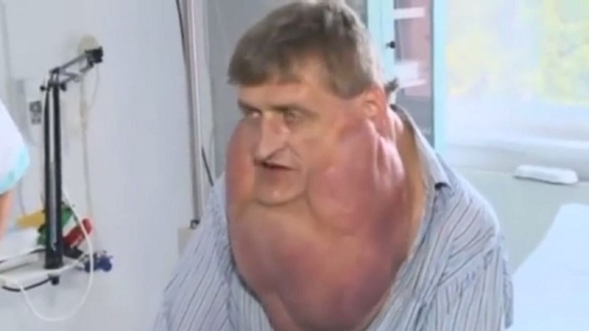 Le extrajeron de la papada un tumor de más de cinco kilos