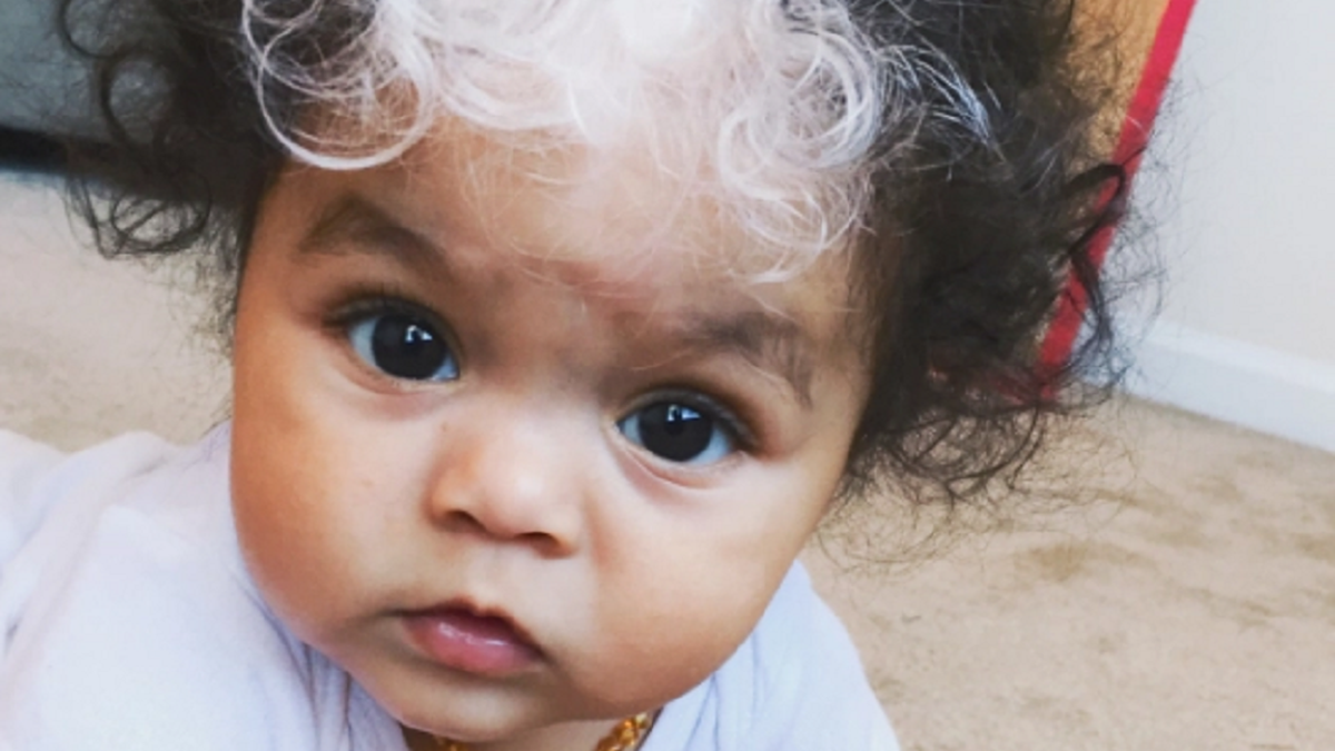 El pelo blanco: una bebé nace con una marca de nacimiento como su madre