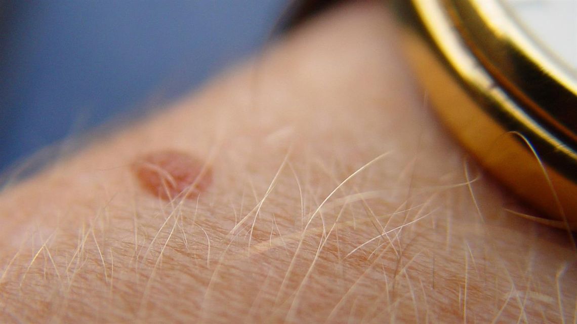 Día Mundial Del Melanoma Cómo Hacer Un Autoexamen Y Evitar El Cáncer A